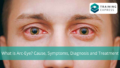 What is Arc Eye? Cause, Symptoms, Diagnosis & Treatment